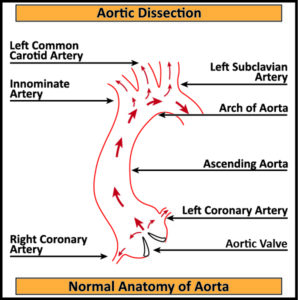 Aortic Dissection Surgery - drkanase.in